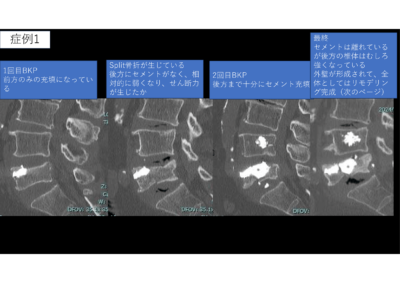 BKP圧迫骨折に対するセメント手術 | 淡海せぼねクリニックブログ